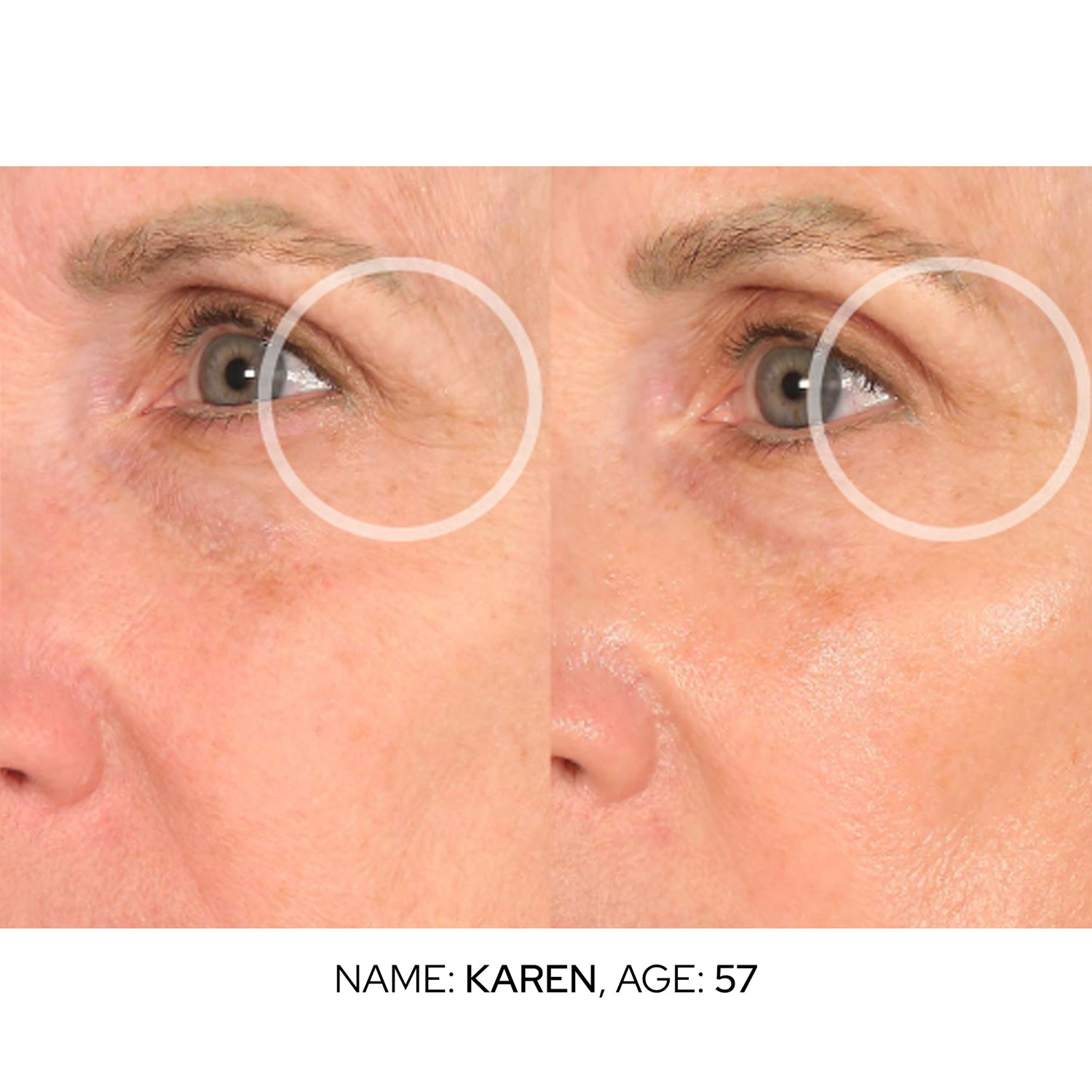 Before and After Skin Wrinkle Treatment Photos | SIO Beauty